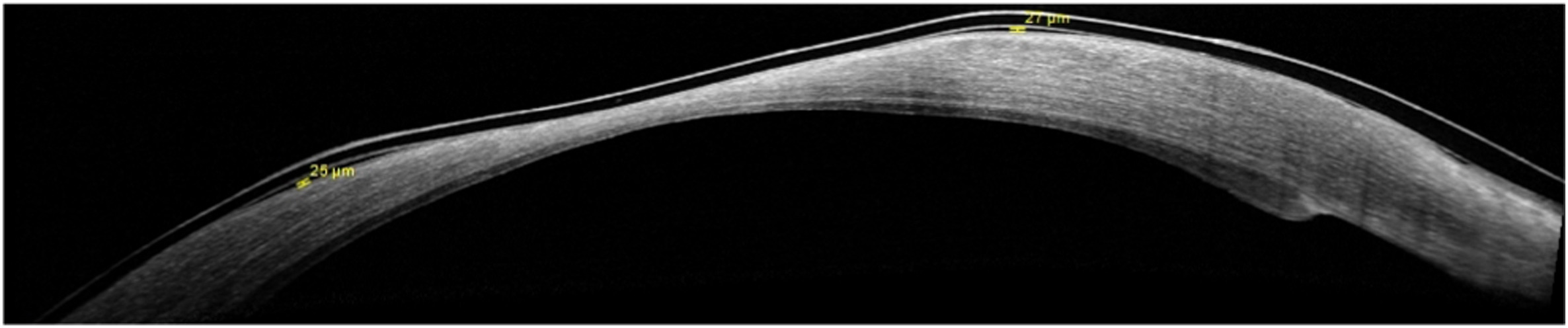 Eficacia de la Lente de Contacto Terapéutica Hyper-CL en un paciente ...