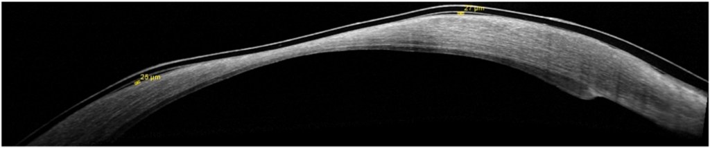 Eficacia de la Lente de Contacto Terapéutica Hyper-CL en un paciente ...