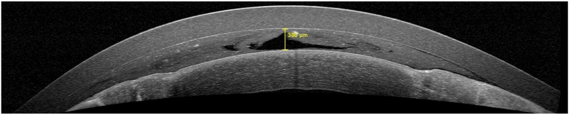 Eficacia de la Lente de Contacto Terapéutica Hyper-CL en un paciente ...